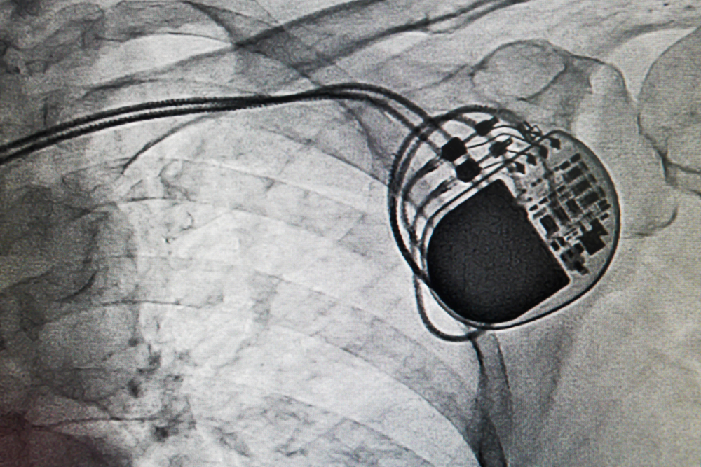 First-Ever Transient Pacemaker Harmlessly Dissolves in Body | Current ...