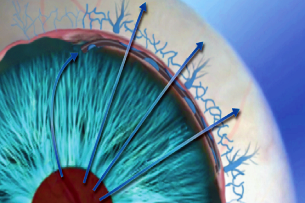 IVANTIS, INC.: Announces Groundbreaking 3 Year Results from FDA ...