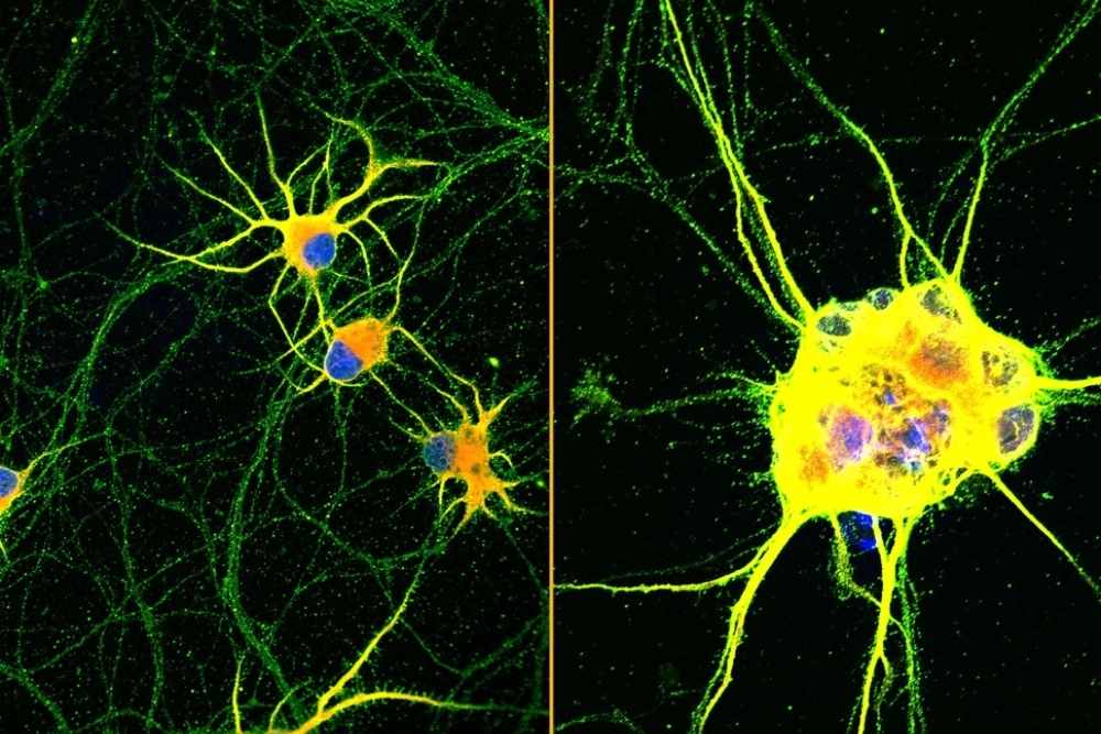 Mature ‘Lab Grown’ Neurons Hold Promise for Neurodegenerative Disease ...