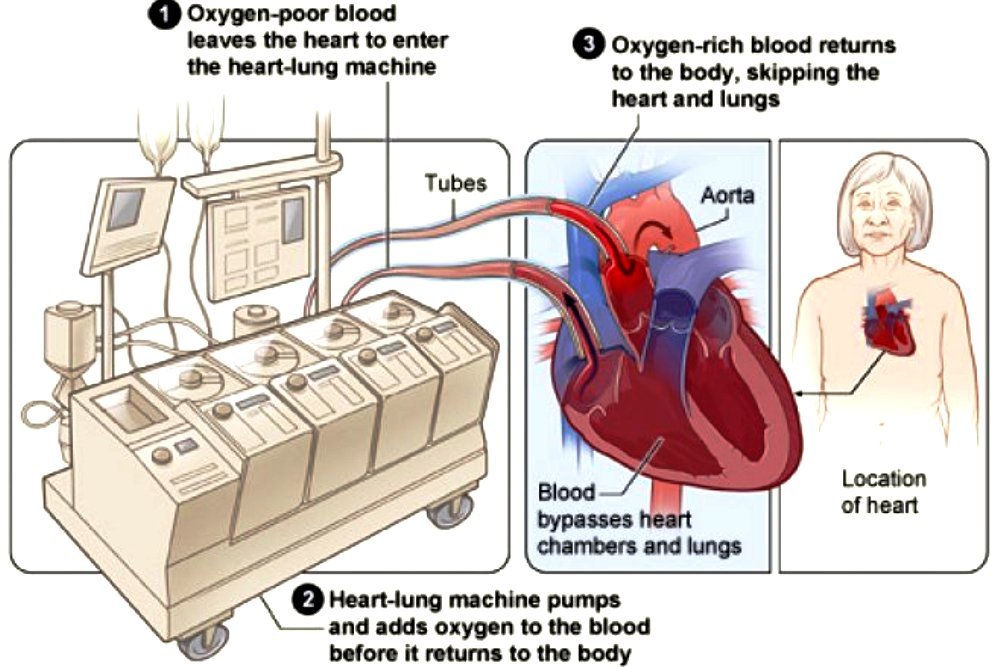 Stony Brook, VA find no gain from 'off-pump' coronary bypass | Patient ...